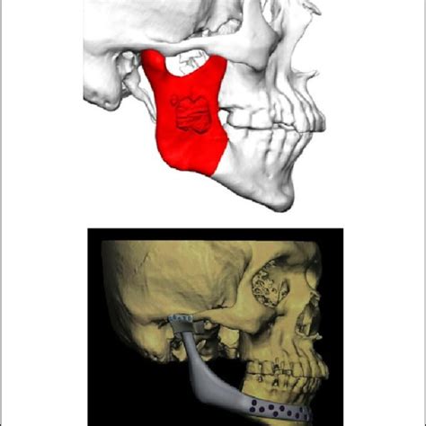 Digital Prediction Of Segmental Resection With Safety Margins Of 1 5 Cm