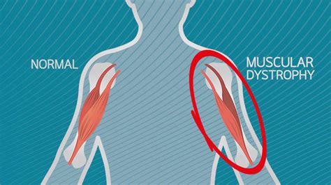 Understanding Muscular Dystrophy Types Symptoms Treatment