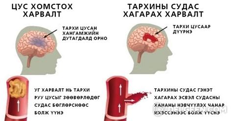 Цус харвалтын үед зүү таны амь насыг аварна Цус харвалт болоход хэрхэн