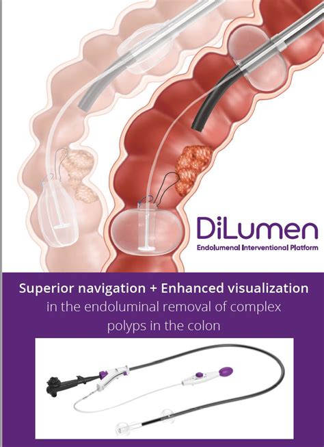 Lasermed Ag Innovating Medicine On Linkedin Dilumen Polypremoval