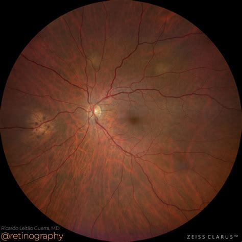 Choroidal Metastases Retinography