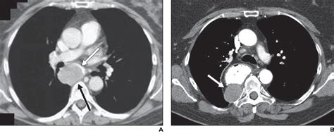 Esophageal Leiomyosarcoma Semantic Scholar