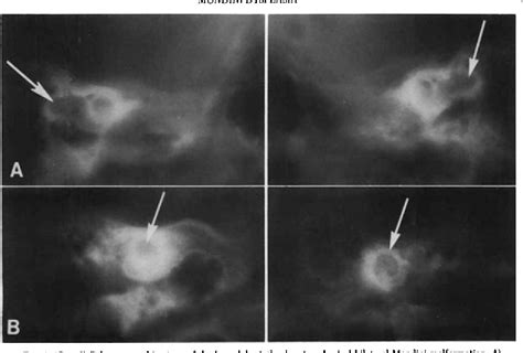 Hidrotic Ectodermal Dysplasia Semantic Scholar
