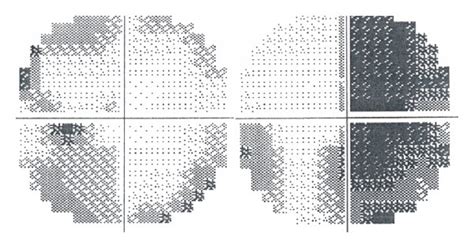 Onset A Preoperative B And Postoperative C Visual Field