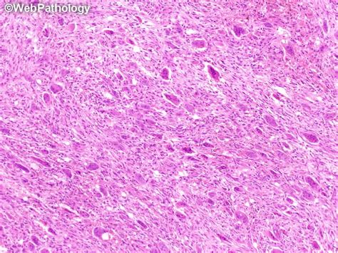 Solid Aneurysmal Bone Cyst