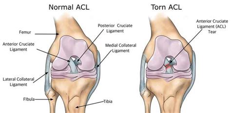 ACL Injury Prevention Equilibrium Sports And Spinal Clinic