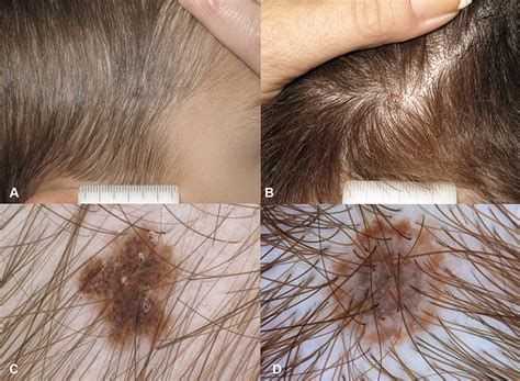Skin Cancer Scalp Lesions