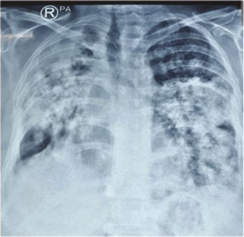 Chest X Ray Pa View Reveals Bilateral Consolidation Nodule With Download Scientific Diagram