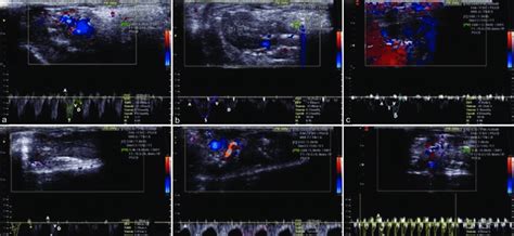 Color And Spectral Doppler Usg Of Hepatic Venous Flow Direction And