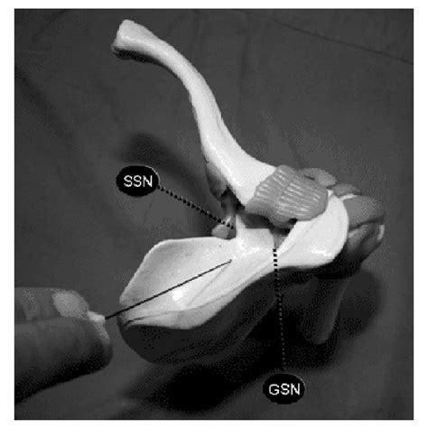 Transverse Ultrasound Image Of Interscalene Brachial Plexus Arrowheads