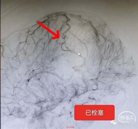 广州医科大学附属第五医院 病例分享：复合手术治疗脑动静脉畸形1例 脑医汇 神外资讯 神介资讯