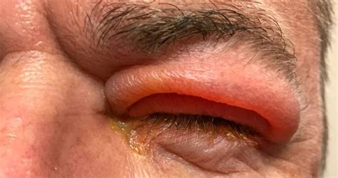 You Can Contract Gonorrhea Gonococcal Conjunctivitisin Your Eyes