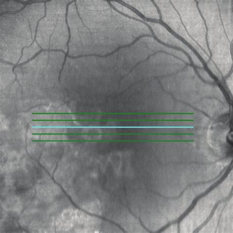Spectral Domain Optical Coherence Tomography Topographic View Of The