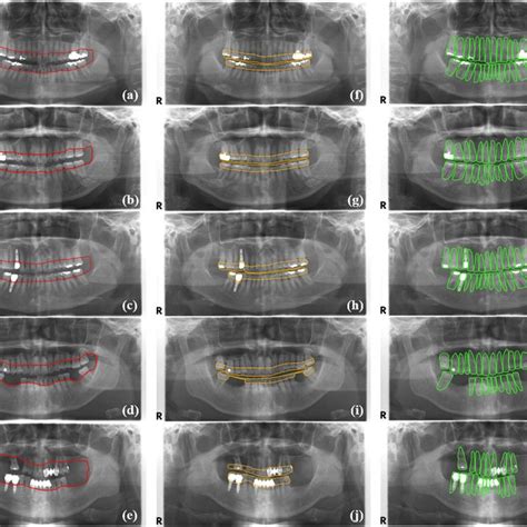 Pdf Deep Learning Hybrid Method To Automatically Diagnose Periodontal Bone Loss And Stage