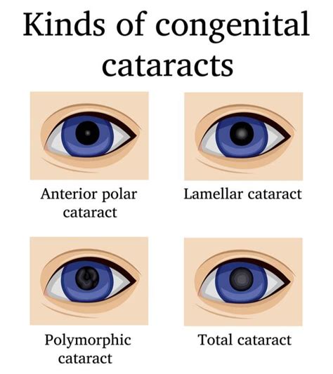 Congenital Cataract Types Causes Symptoms And Treatment