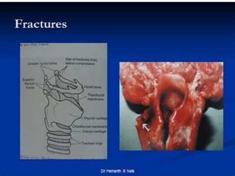 Pathophysiology Of Asphyxia And Drowning
