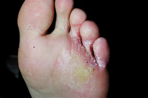 Itchy Skin On Bottom Of Foot Sale