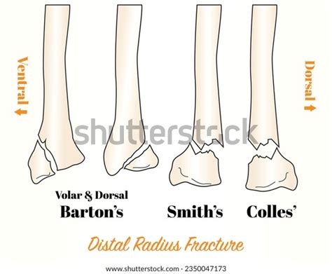 Different Types Distal Radius Fracture Vetor Stock Livre De
