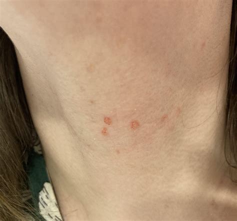 Sudden Red Spots On Neck R Dermatologyquestions