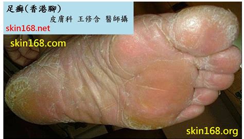 體癬、股癬、足癬與甲癬－皮膚科 王修含醫生｜痞客邦