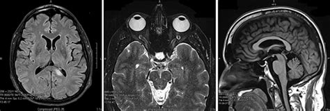 A Mri Of The Brain Showing Infarct Within The Left Splenium B Mri Of