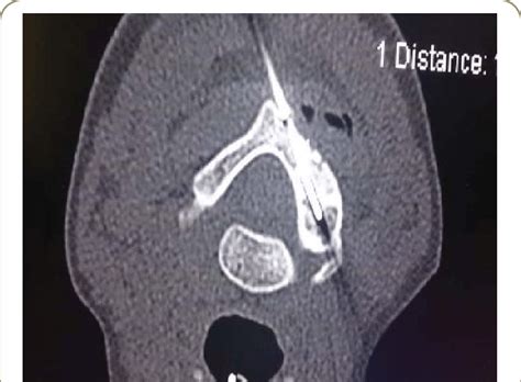 Axial Computed Tomography Image Showing The Radiofrequency Ablation