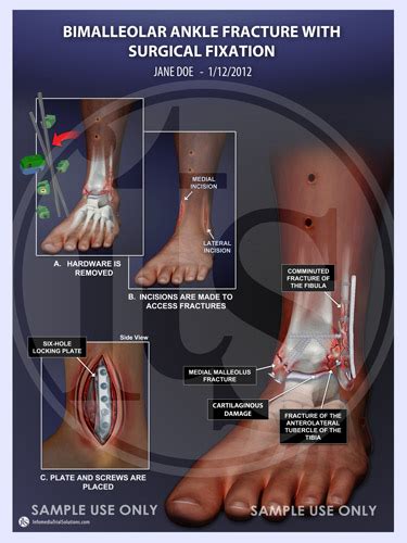Ankle Fracture Bimalleolar Ankle Fracture With Surgical Fixation Infomedia Trial Solutions Inc