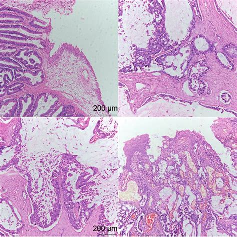 Immunohistochemical Staining Patterns In Urachal Carcinoma A Strong
