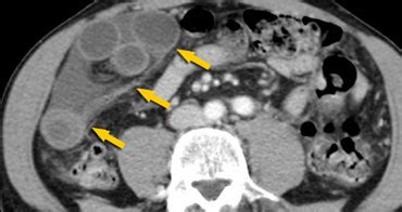 The Radiology Assistant Closed Loop Obstruction In Small Bowel Obstruction