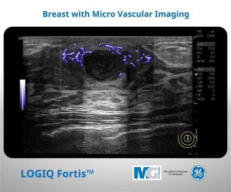 Breast With Micro Vascular Imaging Medigroup Cambodia