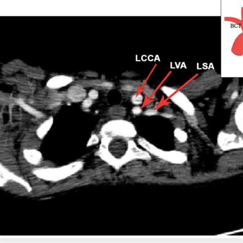 Axial CT Chest Contrast Image Showing Aberrant Right Subclavian Artery