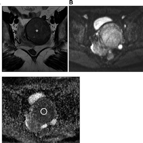 Leiomyosarcoma Axial Fast Spin Echo T2 Weighted A And Diffusion