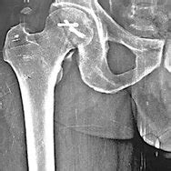 Showing Post Op X Ray Of The Fixation Download Scientific Diagram