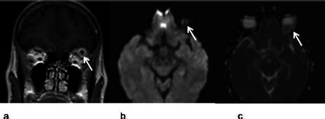 Intraorbitary Metastasis Of Retroperitoneal Leiomyosarcoma A Download Scientific Diagram