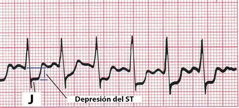 Cómo diferenciar isquemia lesión y necrosis en el ECG