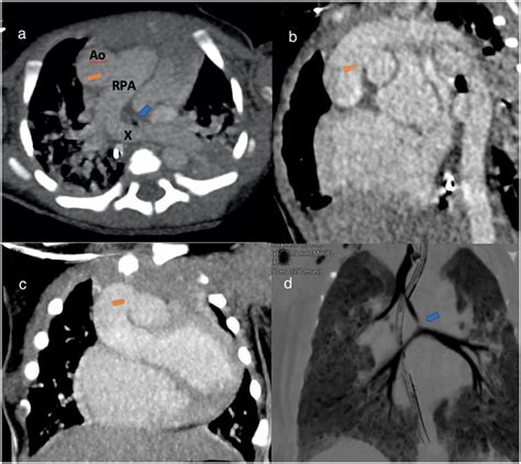 A Ct Angiography Of Axial Oblique Multiplanar Reconstruction Mpr
