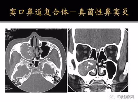别再说难了，手把手教您学鼻腔鼻窦及颅底ct影像解剖