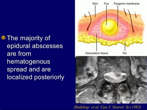 Epidural And Subdural Abscess