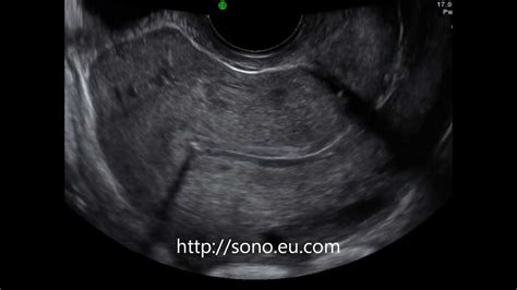 Intrauterine Device On Transvaginal Ultrasound Youtube