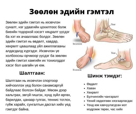 ЗӨӨЛӨН ЭДИЙН ГЭМТЭЛ гэж юу вэ Зөөлөн эдийн гэмтэл нь ихэвчлэн суналт нэг удаагийн цохилтоос