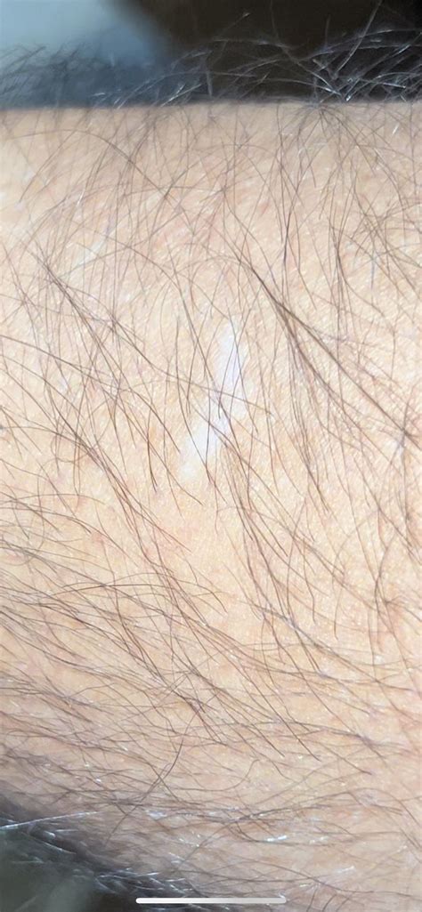 White Patch On Arm Discolored Skin Should I Be Worried Rmedical