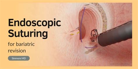 How Can Endoscopic Suturing Be Used For Bariatric Revision