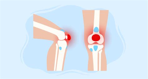 Gonococcal Arthritis Management Tackling Joint Challenges Medtigo