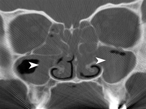 Vasculitis In The Emergency Room The Pivotal Role Of Imaging In