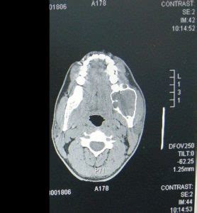 顎骨に痛みのない腫れを生じるエナメル上皮腫ってなに