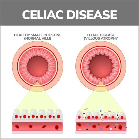 Celiac Disease Signs And Symptoms Gastroenterology Orlando