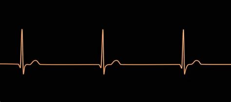 Electrocardiogram Ecg Displaying Junctional Rhythm Which Occurs