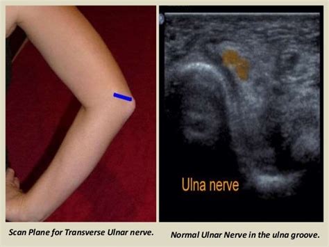 Presentation1pptx Ultrasound Examination Of The Elbow Joint