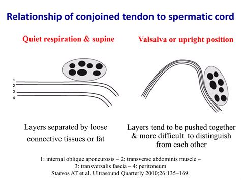 Ultrasound Of Groin And Anterior Abdominal Wall Hernias Ppt