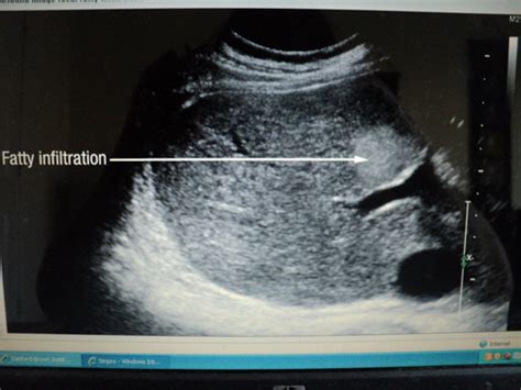 Abnormal Liver Part 1 Vo Flashcards Quizlet